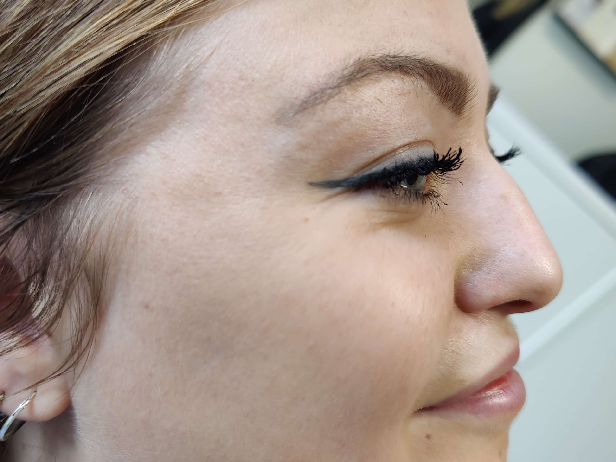 Neus correctie - MIA CLINIC®